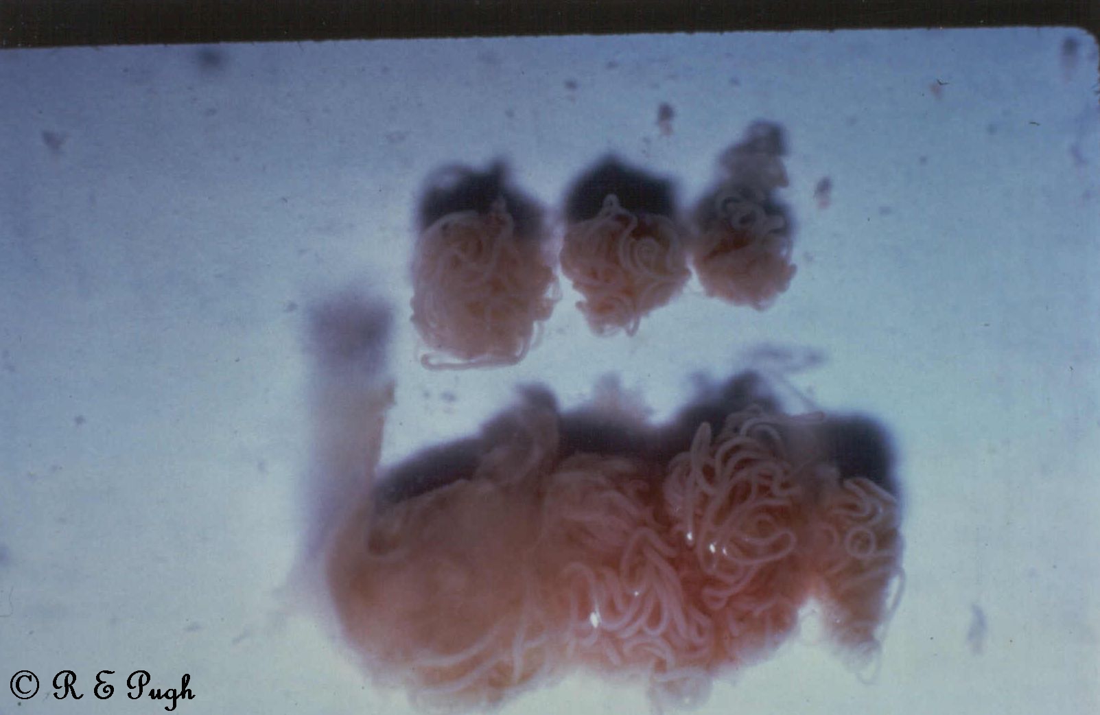 Onchocerca Volvulus Nodules